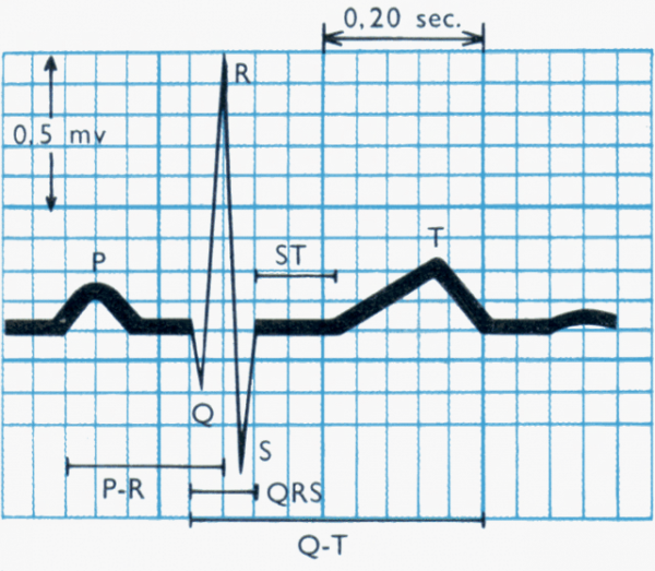 Syndrome du QT Long Congénital (QTL) | Hôpitaux Universitaires Pitié Salpêtrière